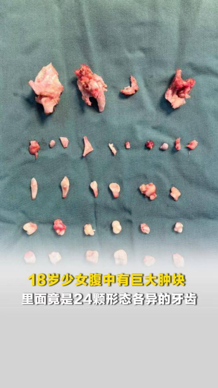 18岁少女腹中有巨大肿块,里面有24颗牙齿,专家:畸胎瘤,多含头发牙齿等