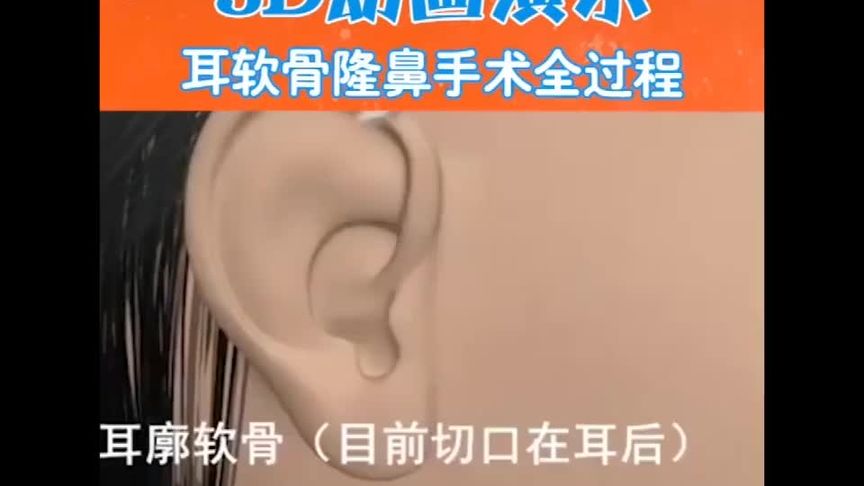 【3D动画演示】耳软骨隆鼻手术全过程。
