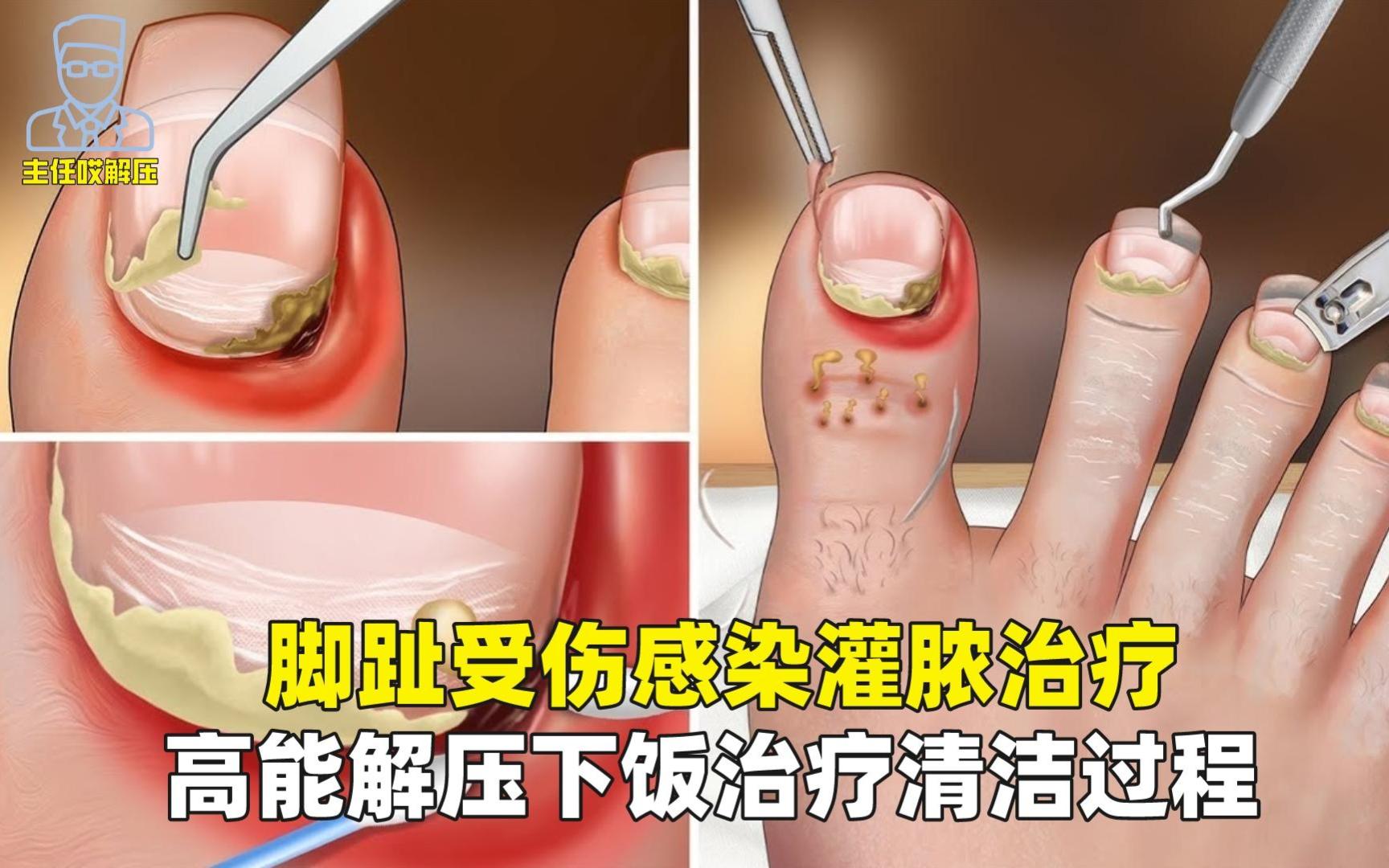 解压动画,脚趾受伤感染灌脓治疗,高能解压下饭治疗清理过程
