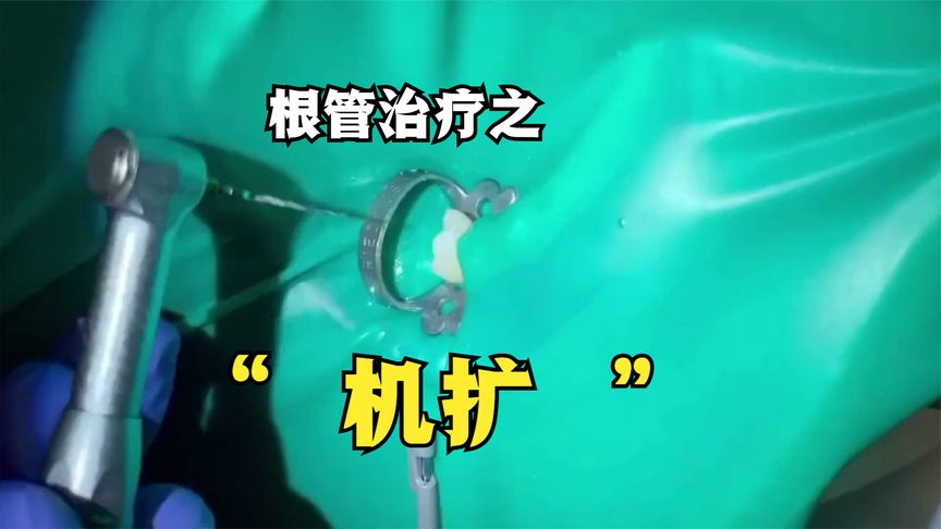 根管治疗术机扩针牙髓治疗牙医治疗牙髓坏死牙根感染口腔齿科器械