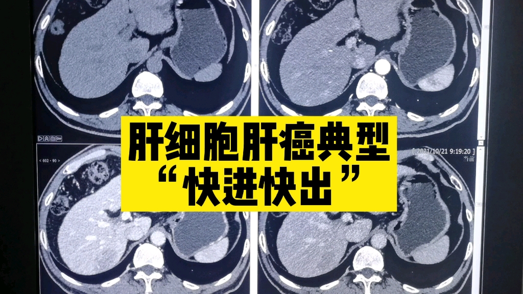 ...肝细胞肝癌典型CT表现—“快进快出”,到底什么意思?肝癌 | 肝硬化