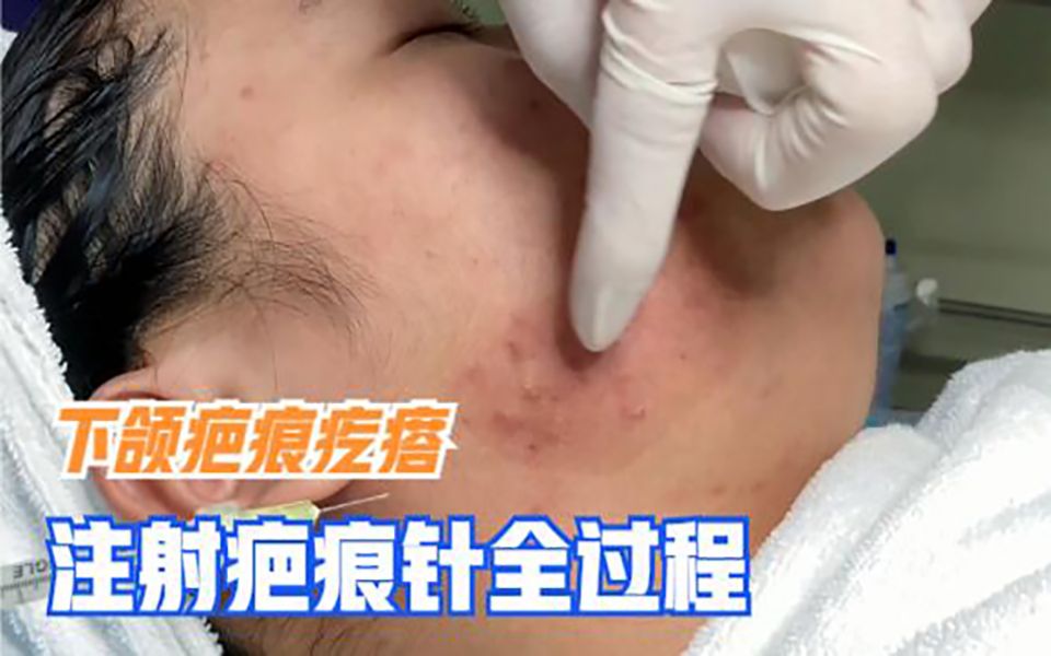 下颌疤痕疙瘩注射疤痕针全过程