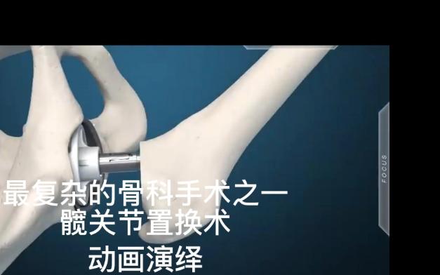 最复杂的骨科手术之一,髋关节置换术