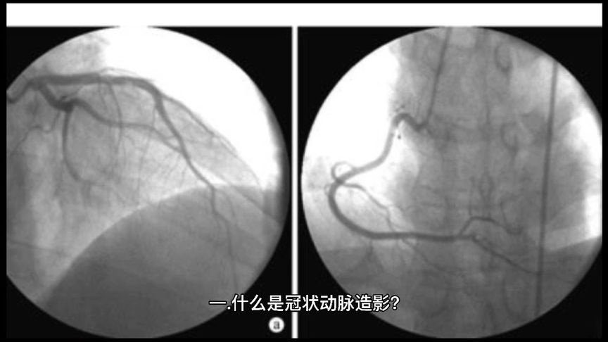 什么是冠状动脉造影?哪些情况要做造影?
