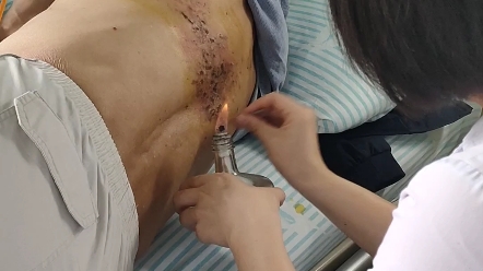 中医专业实习期间,记录跟老师学习带状疱疹的火针疗法,效果很好。