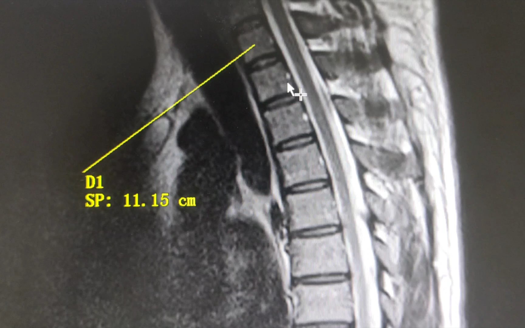 【医学影像知识】脊柱篇-如何快速识别胸1椎体