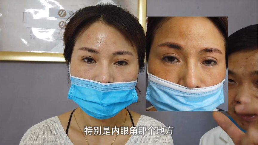 双眼皮修复缺组织 除了表皮的疤痕 剩余组织都是宝贵的 俩月恢复