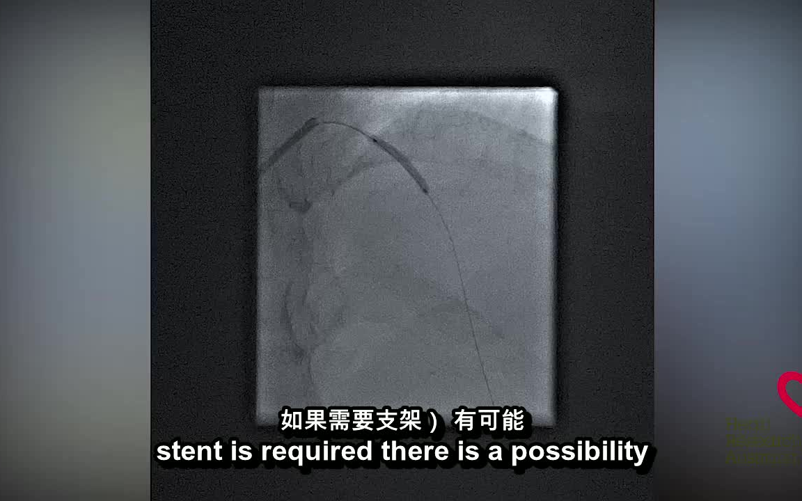 带你了解什么叫做冠状动脉造影(动画)