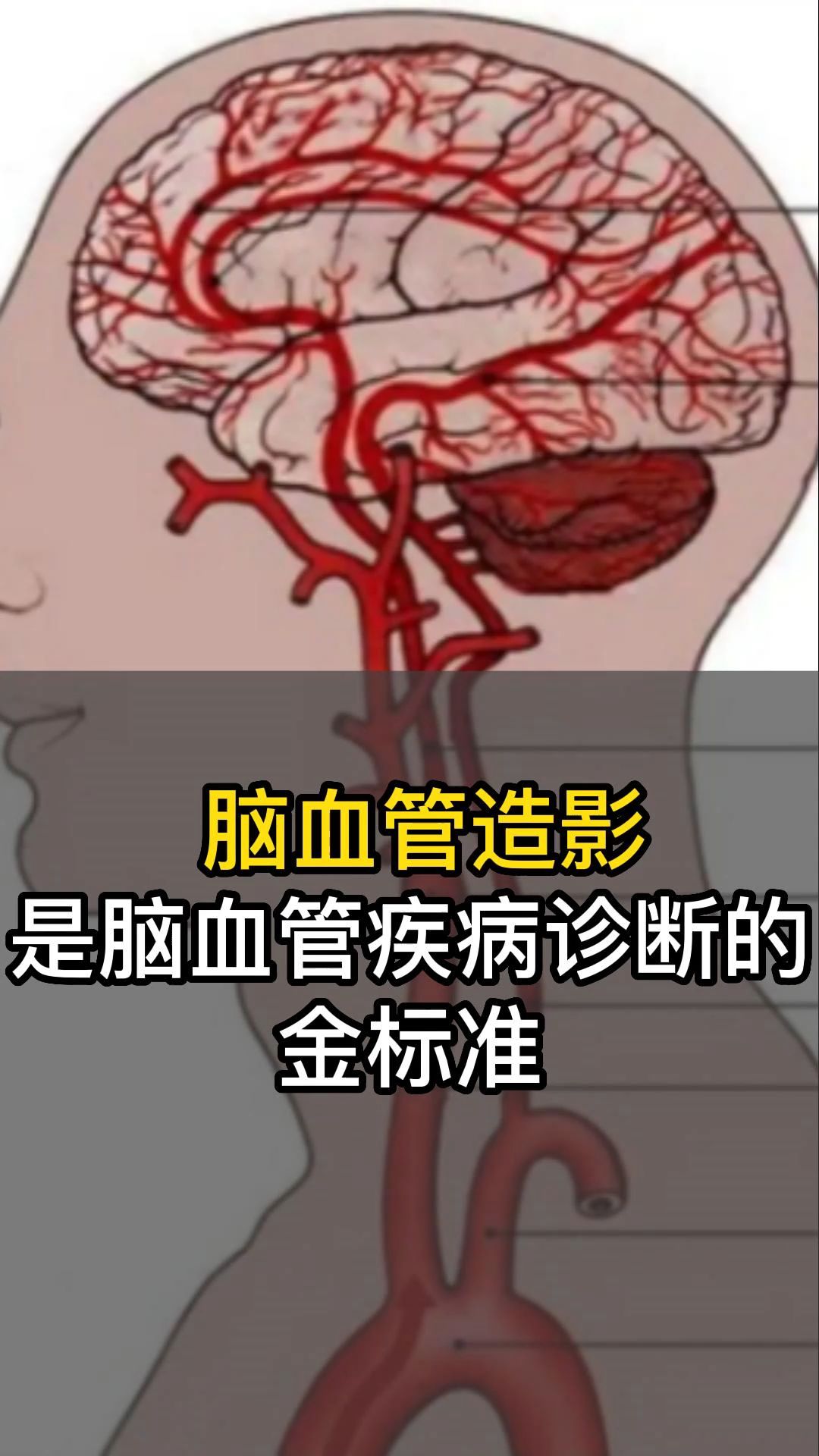 脑血管造影是脑血管疾病诊断的金标准