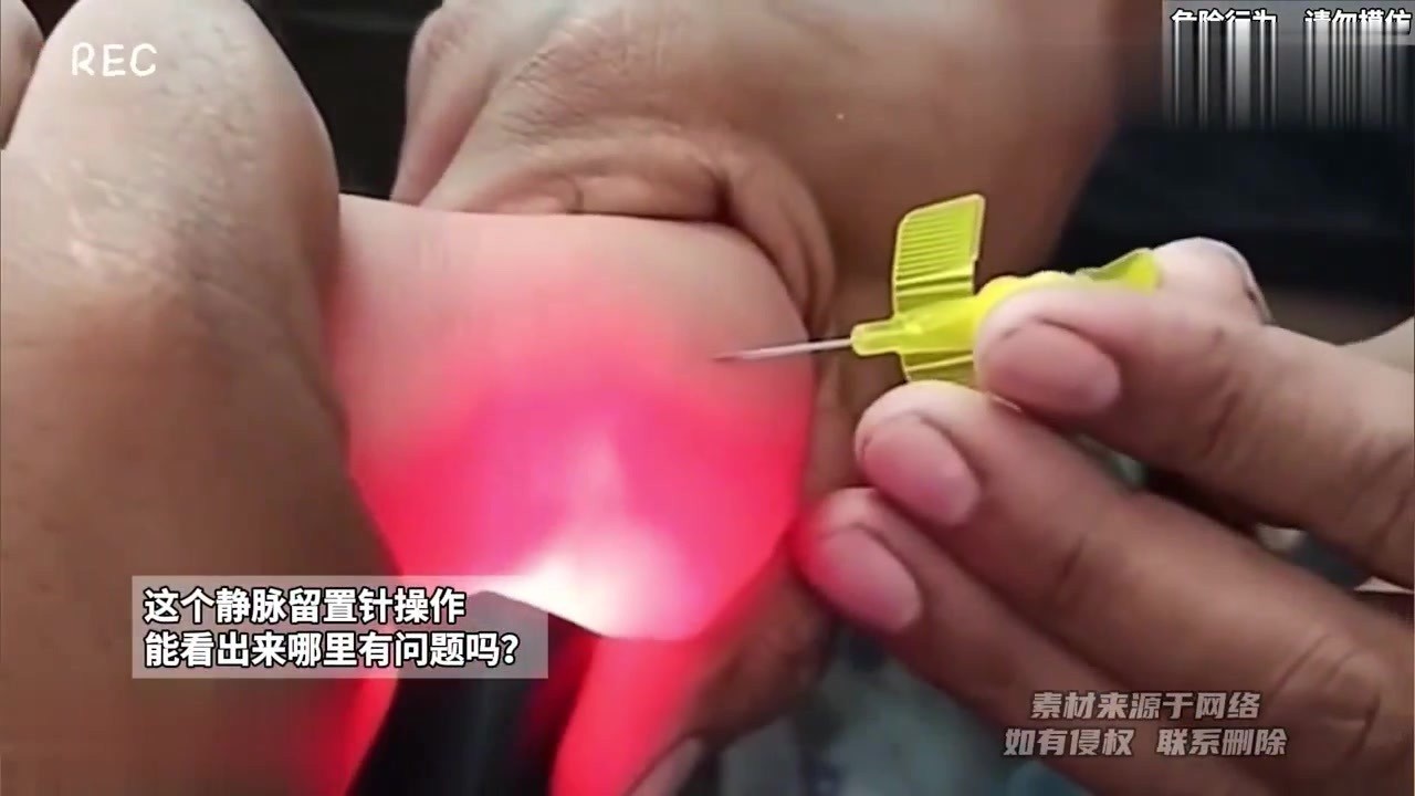 这个静脉留置针操作,能看出来哪里有问题吗?