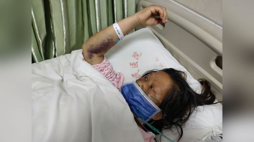 实拍:去医院探望换有急性右肾坏死并尿源性血毒浓症的姐姐。
