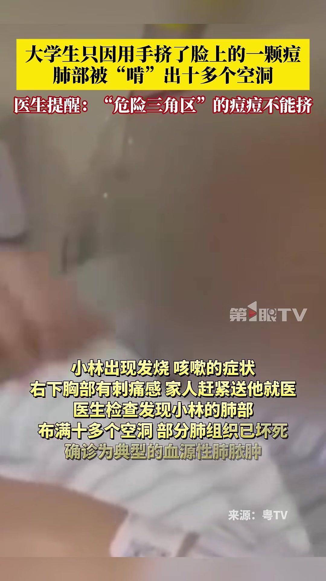 大学生只因用手挤了脸上的一颗痘,肺部被“啃”十多个空洞,部分肺...