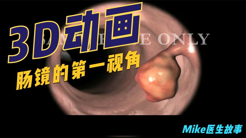 【3D医学动画】跟着第一视角带你看看肠镜是如何做的