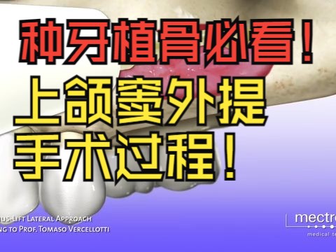 种牙植骨必看!3D展示上颌窦外提手术过程!