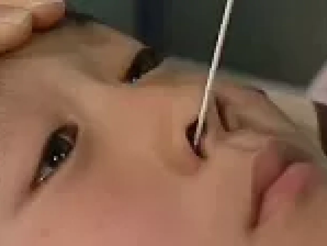 鼻咽拭子采集方法