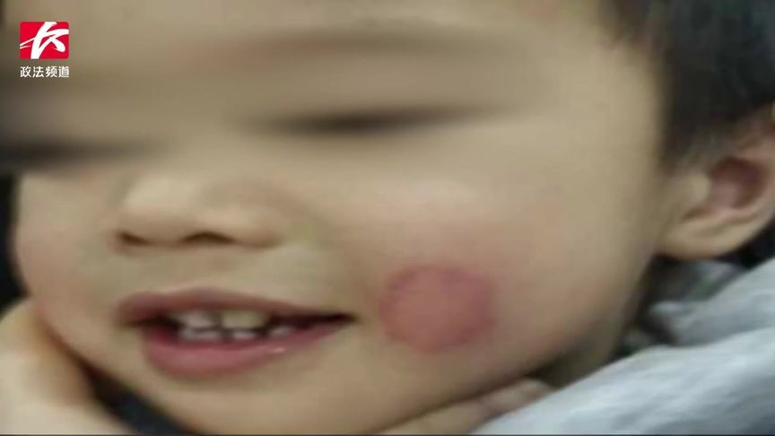 男童幼儿园内被咬伤老师未及时送医,2月后再次被咬家长怒了!