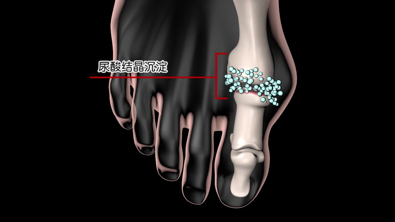 3D建模医学科普 —— 痛风