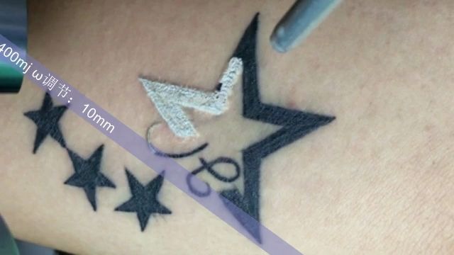 洗纹身视频洗文身洗纹身价格表尚都绅殿医院