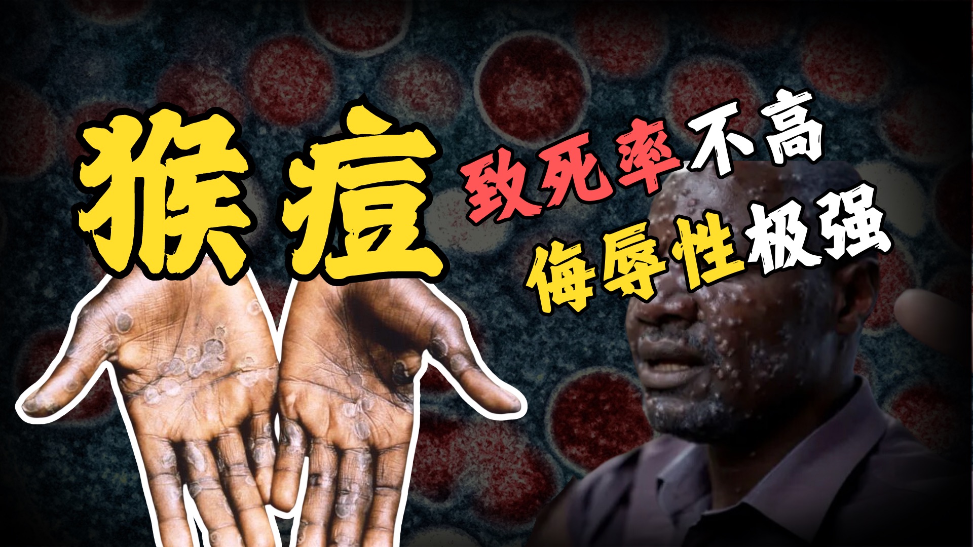 亚洲爆出首例|第二次“疫情”来袭|这次【猴痘】爆发跟2022年有何...