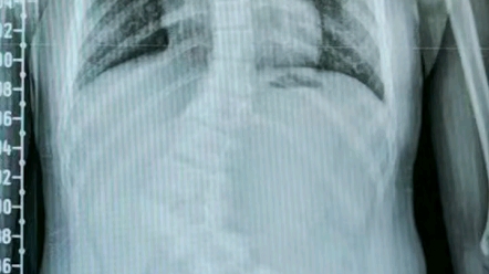 ...向阳院长和盛孙仁主任团队近期过来随访的手术前后的xray病例展示。