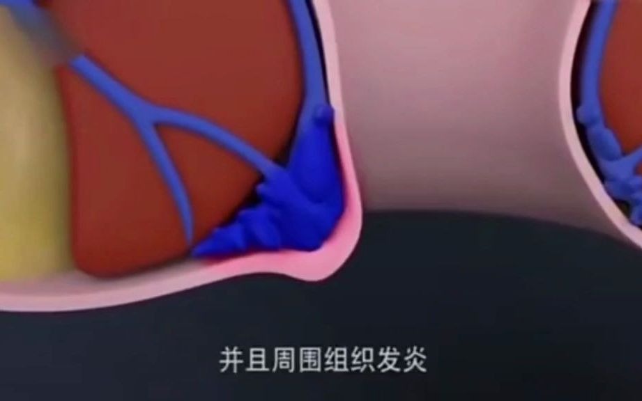 痔疮是怎么形成的能检查吗#?宁夏康源医院看痔疮看的好不好