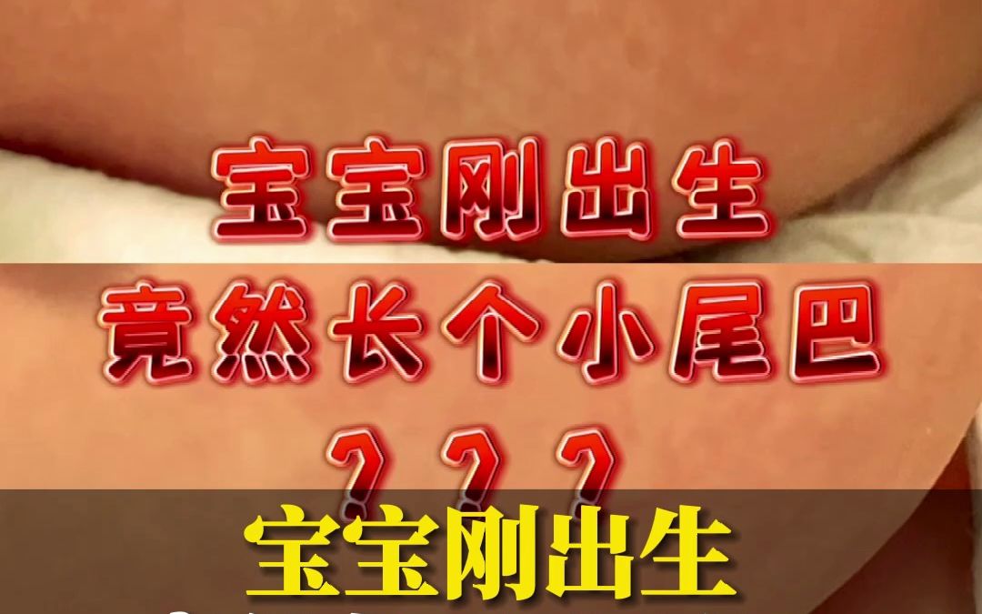 宝宝刚出生,竟然长了小尾巴?