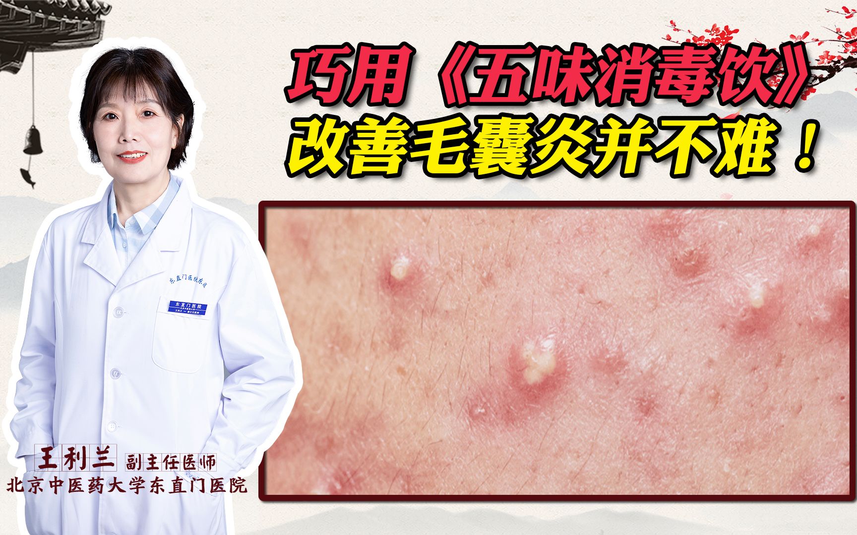 《五味消毒饮》清热解毒 消散疔疮,改善毛囊炎并不难!