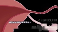异位妊娠 | 双语字幕 | 医学科普