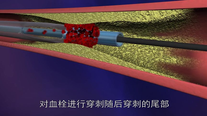 世界首款血栓切除系统,3d动画演示全程,清除迅速60秒拯救千万人