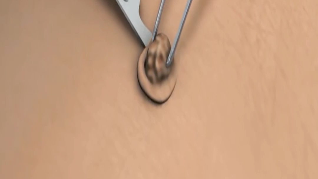 皮肤上的疣去除三维动画演示