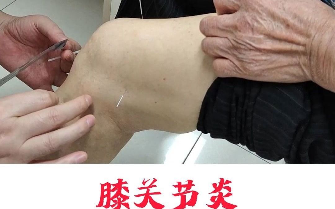 膝关节炎 中医保守治疗常取膝阳关 曲泉 血海 阳陵泉 阴陵泉