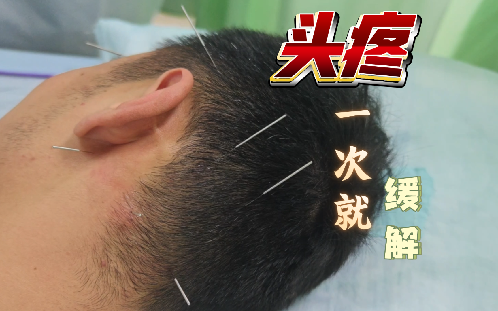 头疼要穴 | 凤池、完骨、丝竹空透率谷…