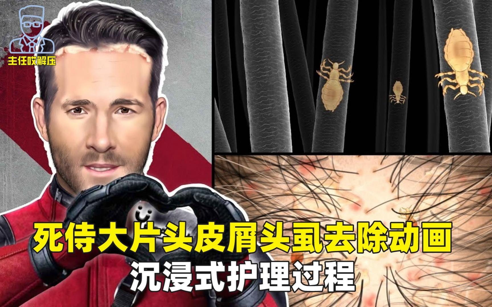 解压动画,死侍大片头皮屑头虱去除动画,沉浸式护理过程