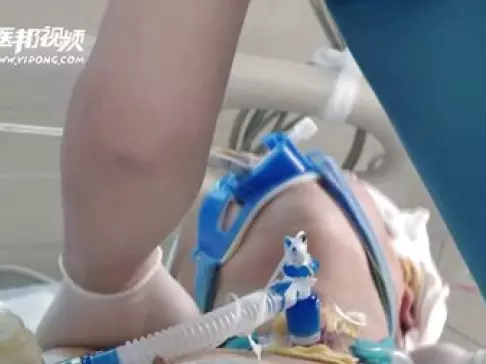 经皮旋转气管切开技术——崔晓岗