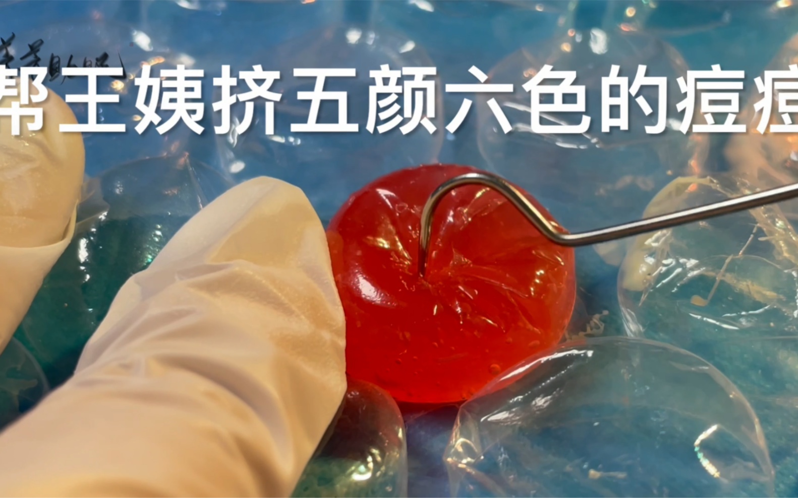 芳芳助眠:帮王姨挤一下大痘 特别多痘