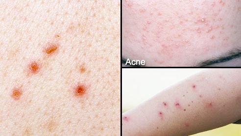 皮肤老是騒痒起红点疙瘩是什么导致的,这方法轻松搞定