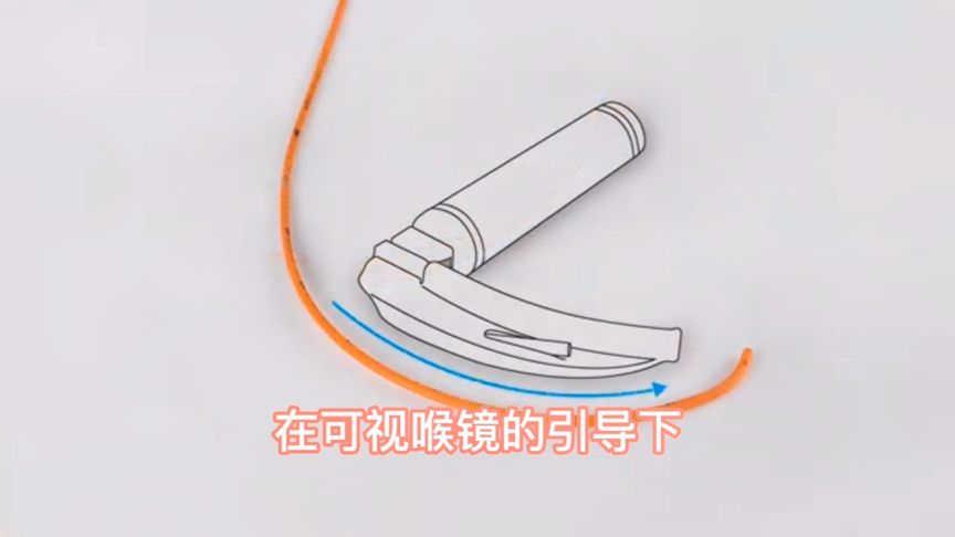 全麻手术需要的气管插管术展示,还好是睡着后做的,不然痛死了!