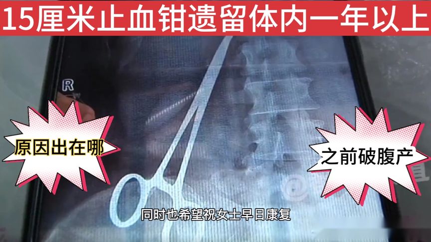 15厘米止血钳遗留体内,产后腰越来越痛,医院暂未发现手术器具少