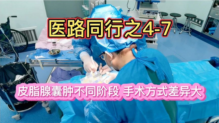 皮脂腺囊肿不同病程阶段 手术方式差异大