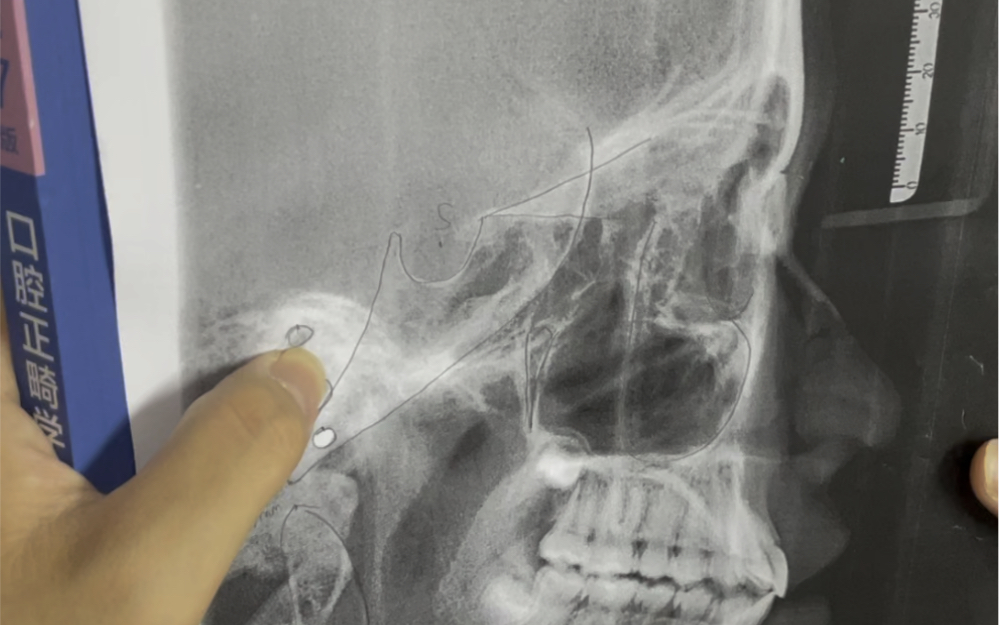 正畸-头影测量描点