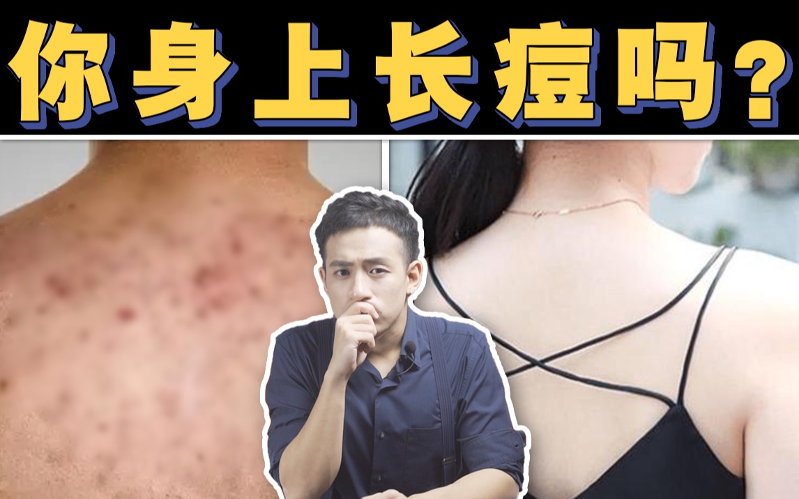 【医学博士】后背、下巴全是痘怎么办?I 身上的痘痘如何治疗?