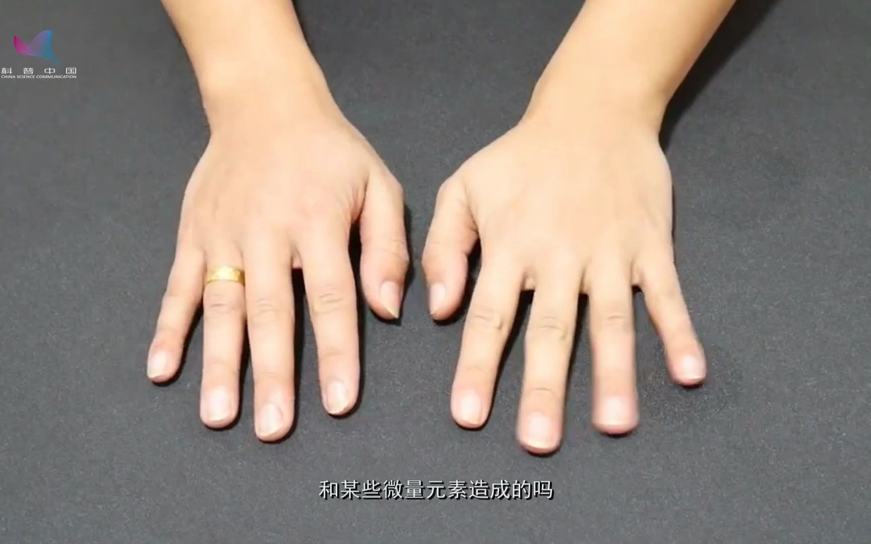 手上长倒刺是缺乏维生素吗?