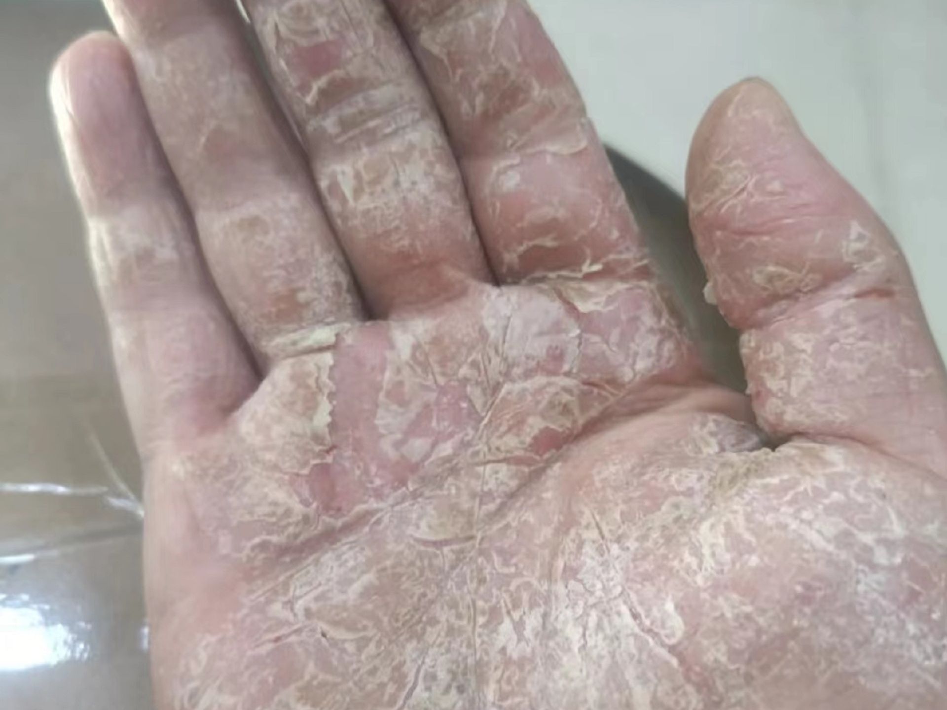 手掌干裂还爆皮?分享这一土方法,一个礼拜轻解决爆皮,修复干裂!