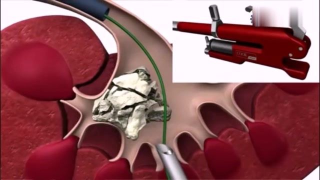 3D演示肾结石微创手术全过程,做过就知道有多疼,赶紧多喝水吧