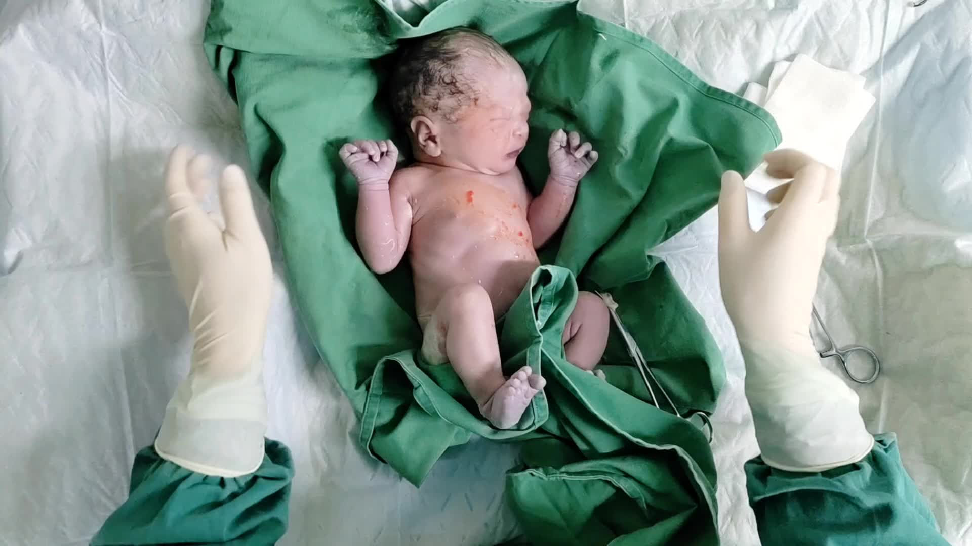 #胎儿生长受限 孕期严密监测⚠️足月剖宫产 出生后予以晚断脐✅评分...