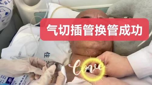 气切插管换管成功下一步气切插管封管改变家庭命运是我们的职责