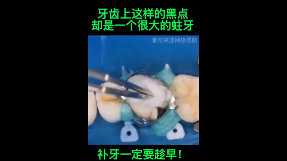 ...树脂补牙门牙补牙自己补牙真实记录补牙全过程 看完你还怕补牙吗深圳