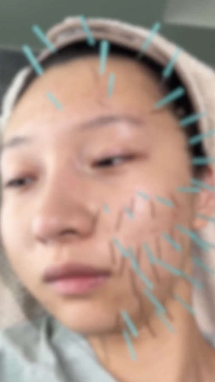 女子针灸祛痘脸上被扎100多针:扎完皮肤变亮了,不是心理作用