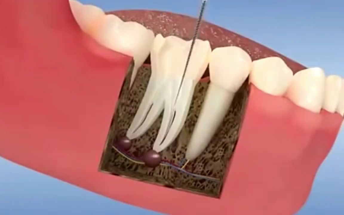 3D动画演示:牙齿根管治疗