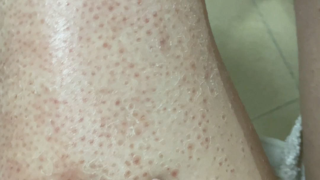 他扎罗丁乳膏去鸡皮的过程记录